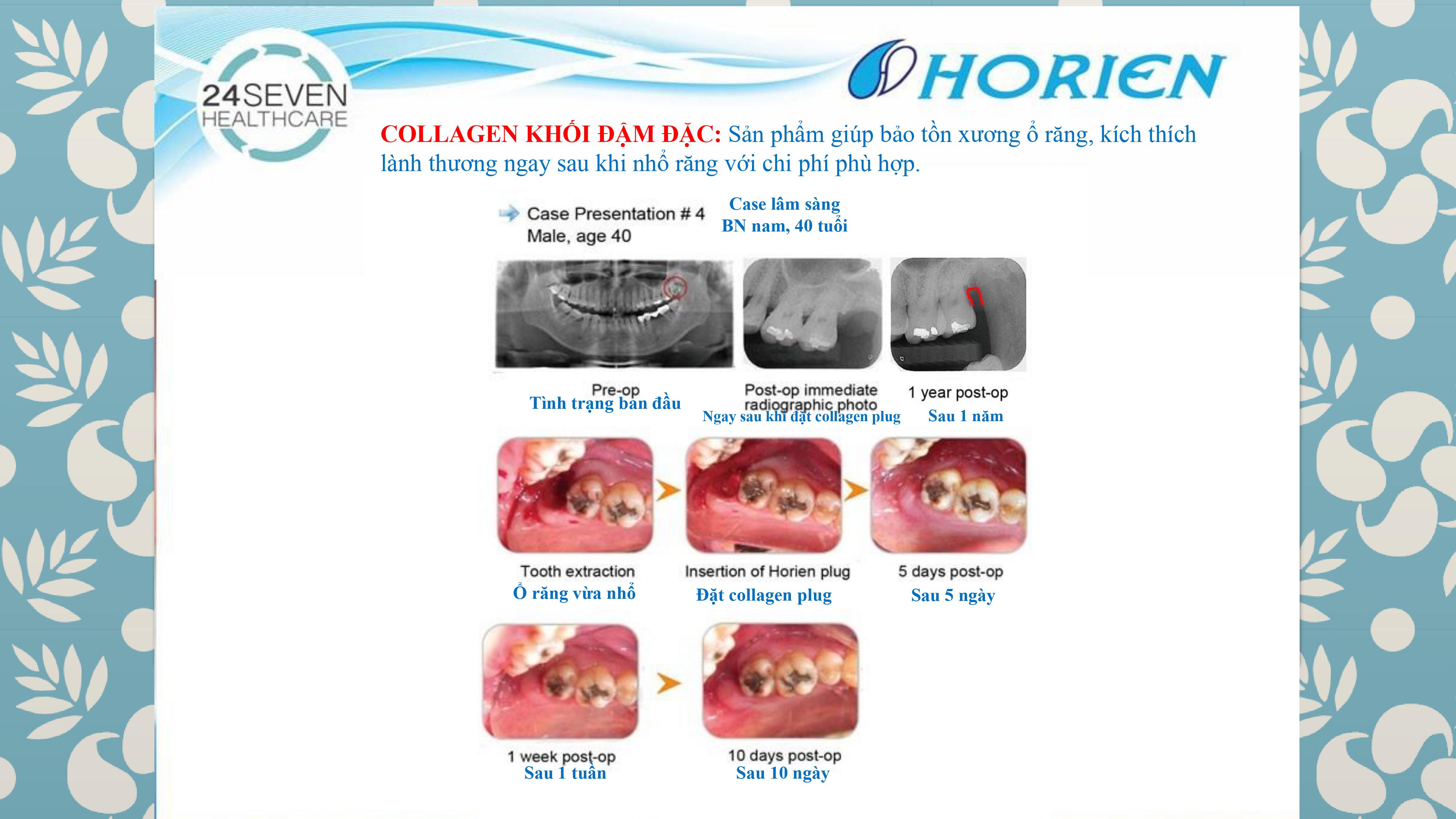 HORIEN COLLAGEN PLUG - 24 SEVEN HEALTH CARE VIET NAM